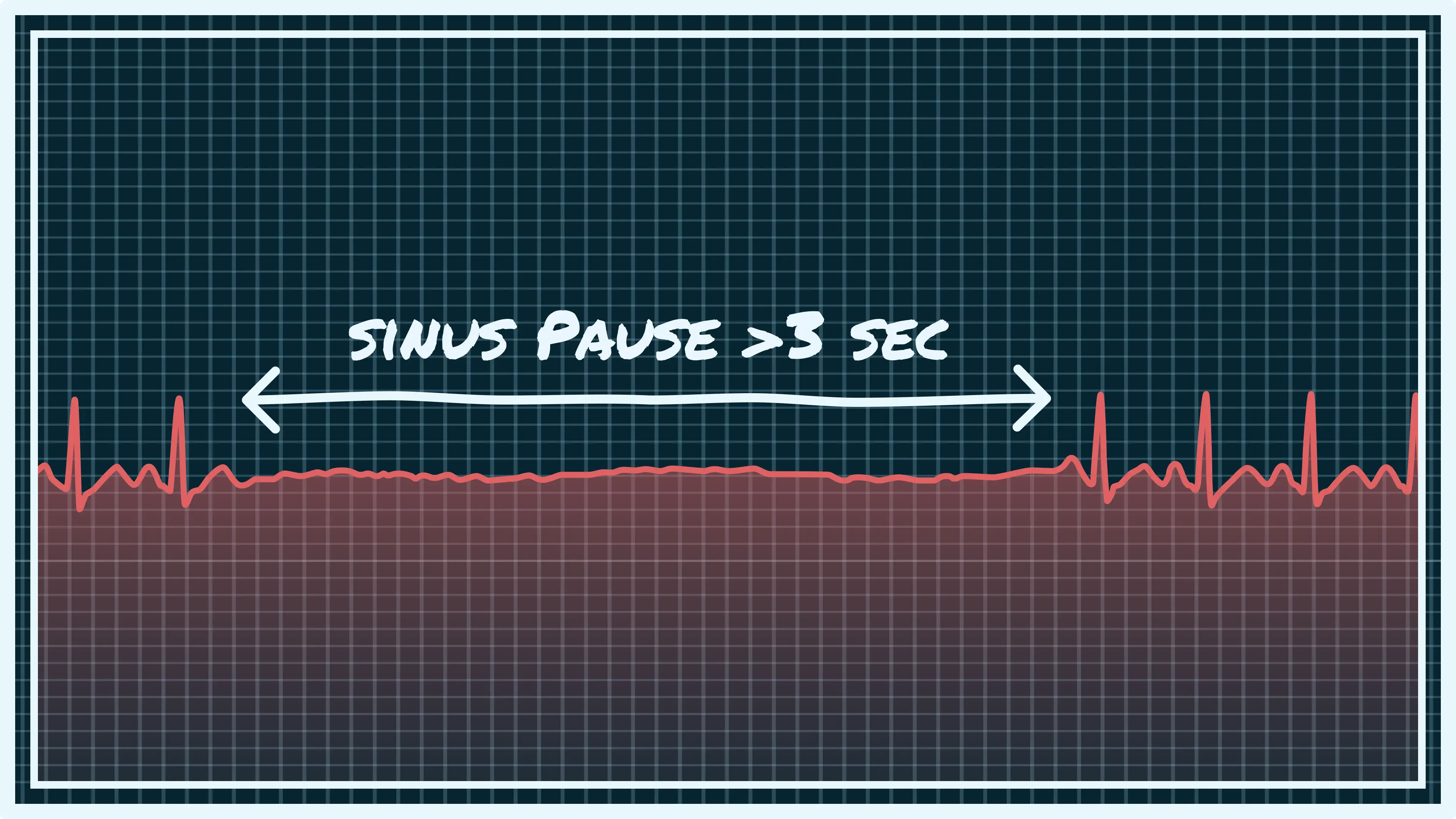 What Sinus Pause >3 Seconds Looks Like on Your Watch ECG | Qaly